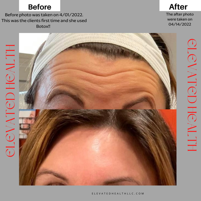 Botox Services, Wrinkle Reduction | Douglas, WY | Elevated Health LLC